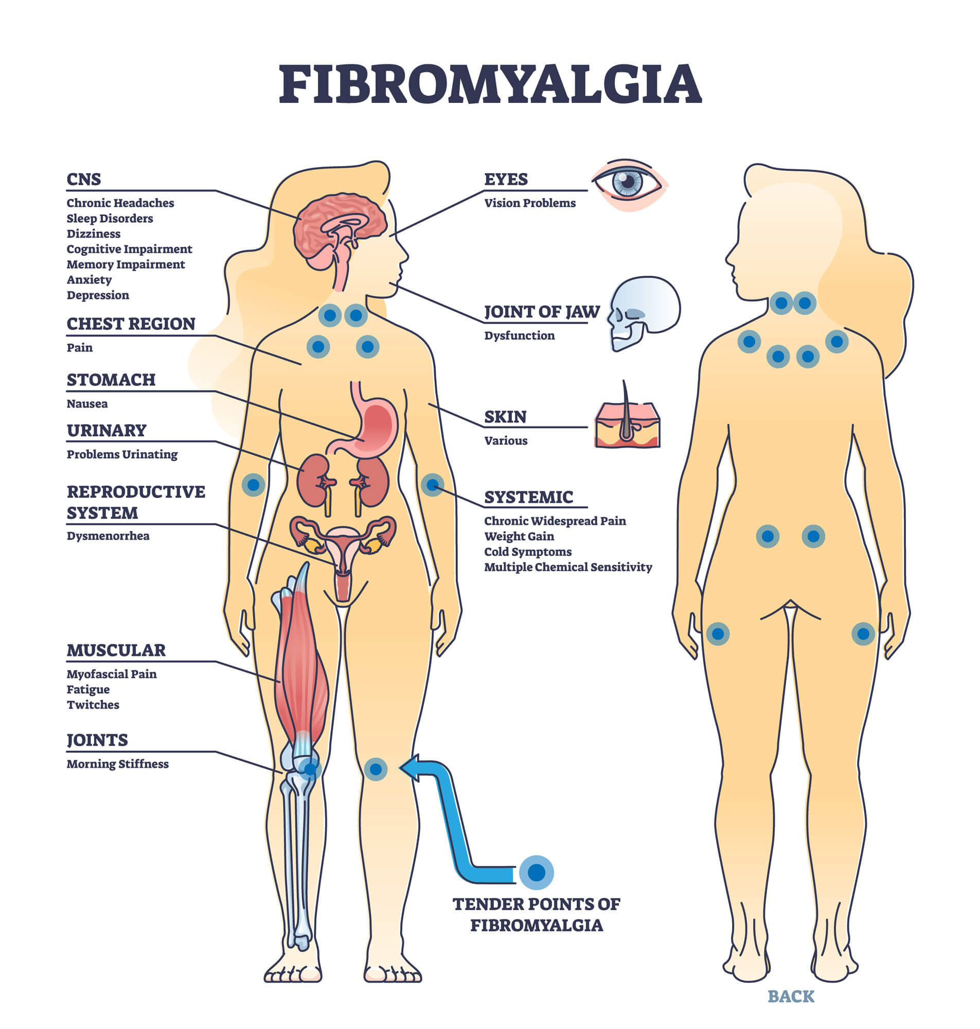 Fibromyalgia - Symptoms, Causes, and Natural Treatment! Fibromyalgia - Symptoms, Causes, and Natural Treatment!